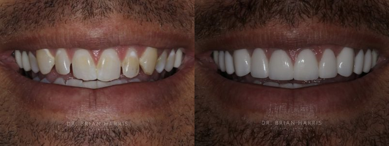 Dr. Brian Harris | Veneer Consult